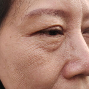 Skin Laxity & Sagging - SKIN Clinics