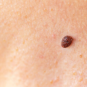 Benign Lesion Removal - SKIN Clinics