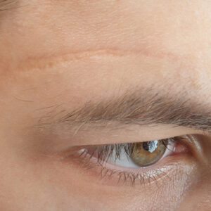 Scar Steroid Injection - SKIN Clinics